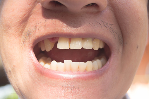 Have You Lost a Front Tooth? Learn What to Do and What Your Options Are ...