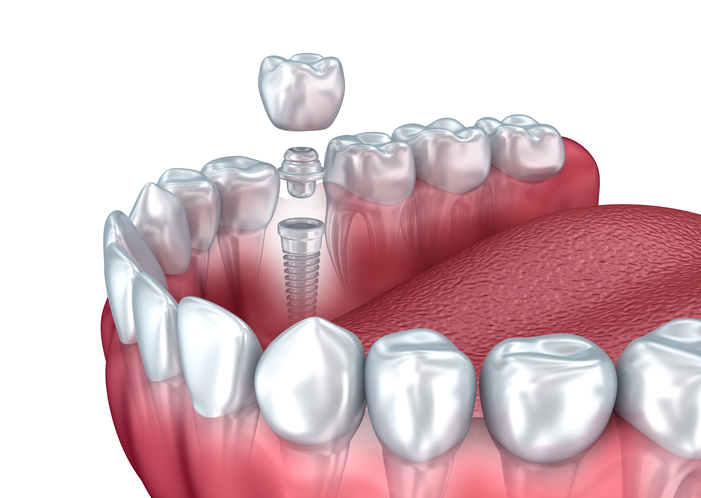 Keep Your Jaw Strong and Prevent Bone Loss with Dental Implants - Call ... Keep Your Jaw Strong and Prevent Bone Loss with Dental Implants - Call ...