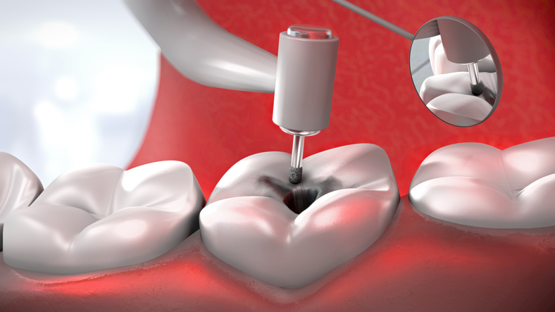 Everything You Need to Know About Getting a Filling - Call Today 855 ...