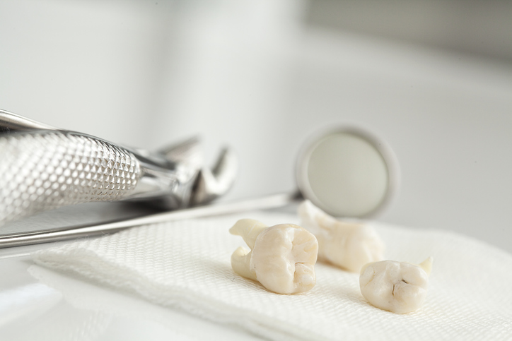 Do You Need to Have Your Tooth Pulled? 4 Reasons it May Be the Best ...