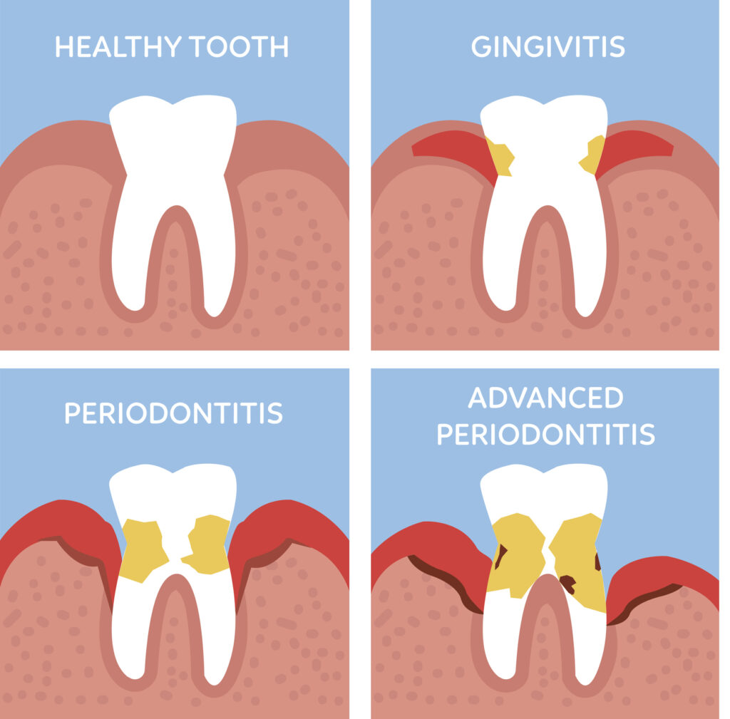 Learn the Core Causes of Gingivitis and How Your Dentist Can Help You ...