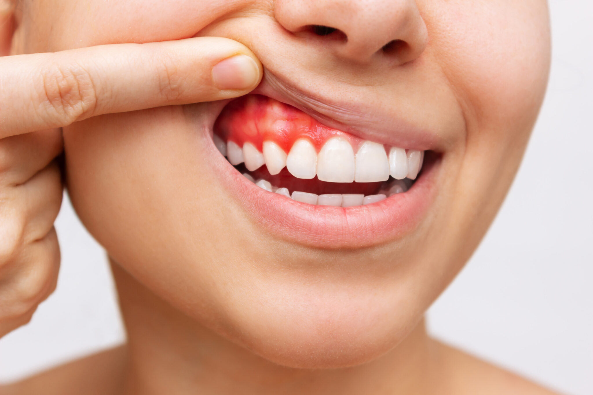 Are Your Gums Puffy? Learn About Steps You Can Take to Treat Puffy Gums ...