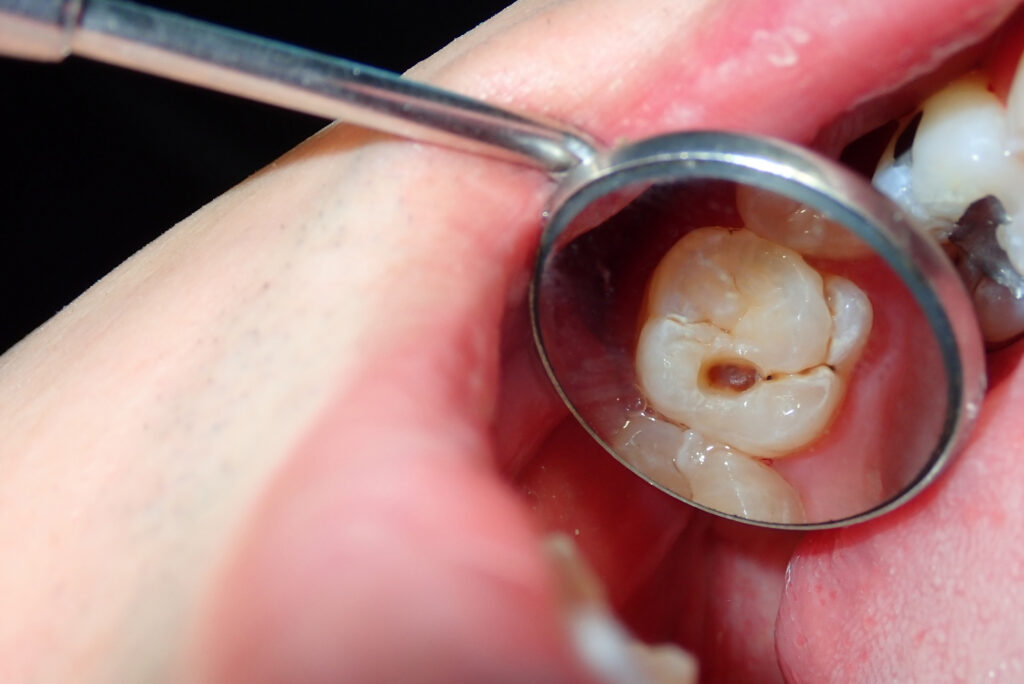 Four Surprising Facts About Cavities You Should Know - Call Today 855 ...