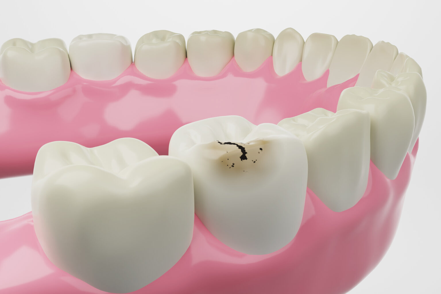 Recognizing the Signs of a Cavity: When to See a Dentist - Call Today ...
