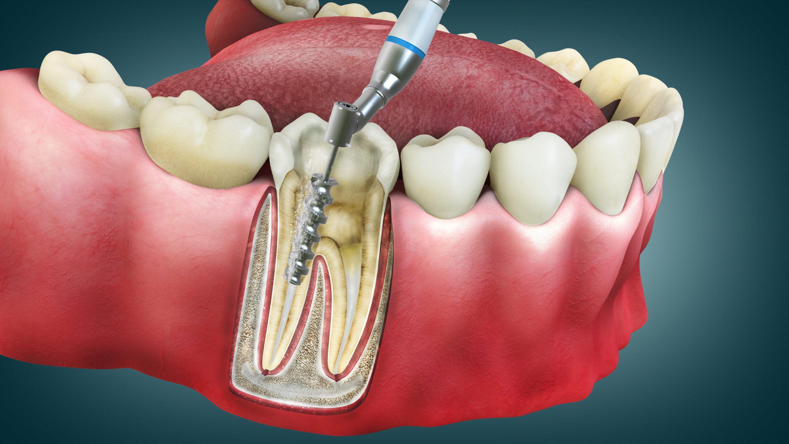 Debunking Root Canal Myths: The Truth About Pain and Relief - Call ...