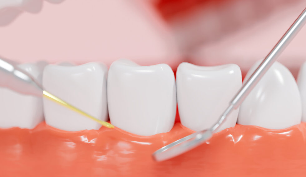 Why Periodontal Maintenance Is Just as Important as Treatment - Call ...